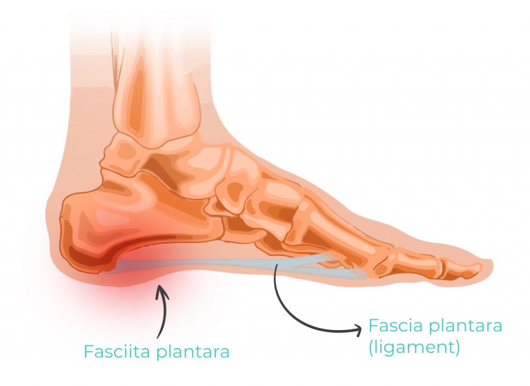 Fasciita plantara – ce este si cum o tratam - Criosfera Recoup